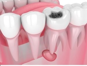 Jaw Cyst Removal - Appledore Dental & Implant Centre